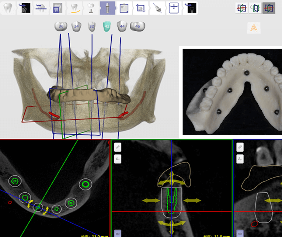 雅客智慧口腔种植系统，安全、精准、高效、微创的数字化口腔医疗机器人！