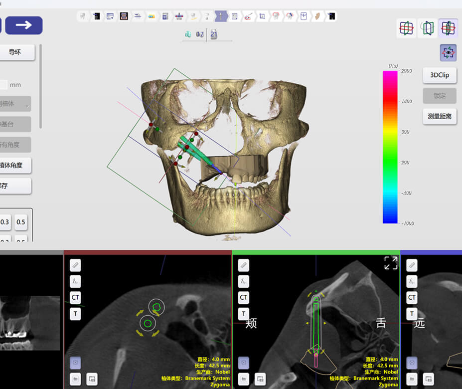 雅客智慧口腔种植系统，安全、精准、高效、微创的数字化口腔医疗机器人！