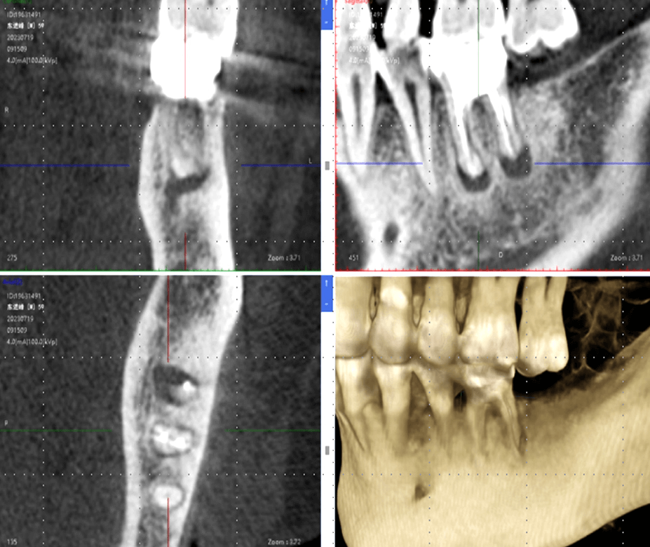 雅客智慧口腔种植系统，安全、精准、高效、微创的数字化口腔医疗机器人！