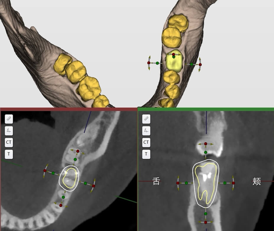 雅客智慧口腔种植系统，安全、精准、高效、微创的数字化口腔医疗机器人！