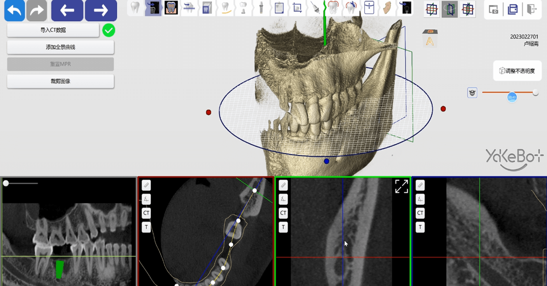 雅客智慧口腔种植系统，安全、精准、高效、微创的数字化口腔医疗机器人！